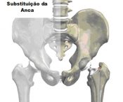 Artroplastia da Anca (Prótese Total da Anca) - CROB