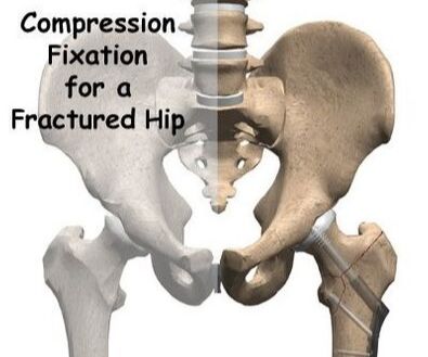 Osteossíntese com DHS na Fratura da Anca (colo do fémur) - CROB